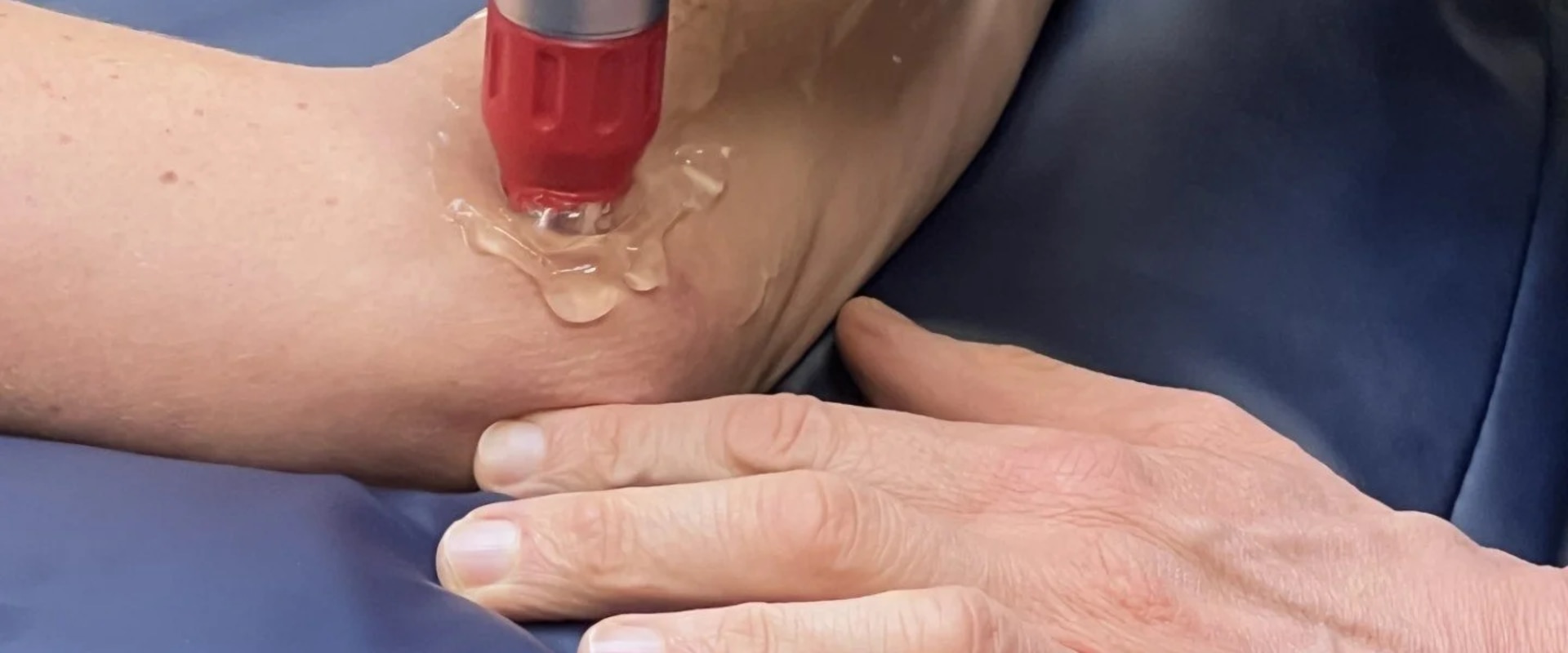 What to expect after shock wave therapy?